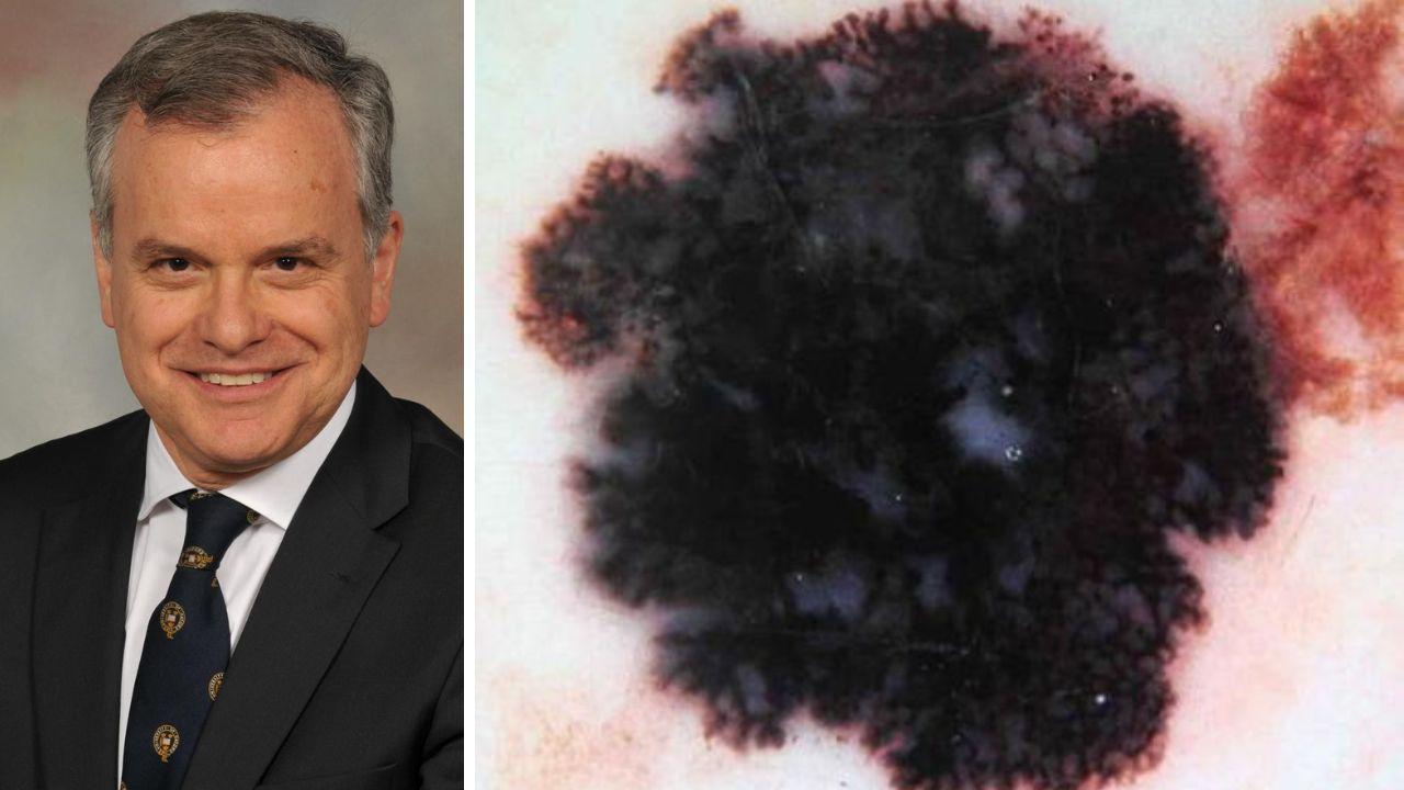 Melanomi e tumori della pelle, come riconoscerli: sintomi e cure - Il ...