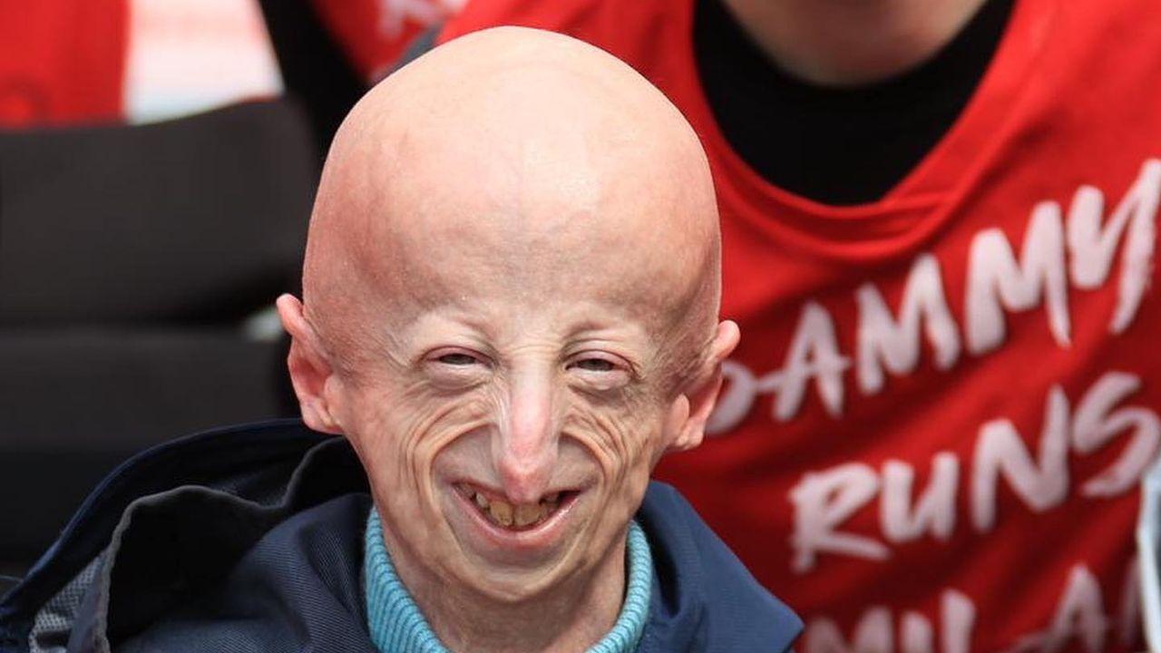 Progeria, morto Sammy Basso: aveva 28 anni. Chi era e la sua malattia ...