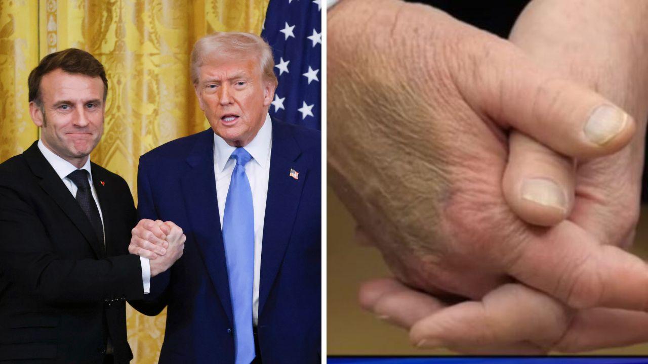 Donald Trump Livido Mano: Cause e Spiegazioni Ufficiali - Il Tirreno